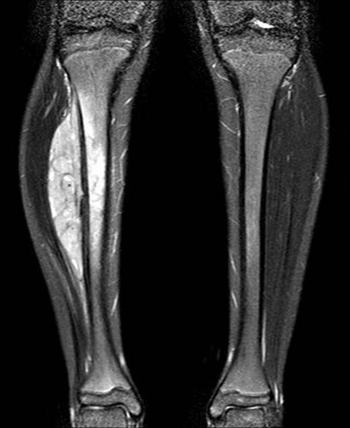 Sarcoma de Ewing - Diagnóstico Journal
