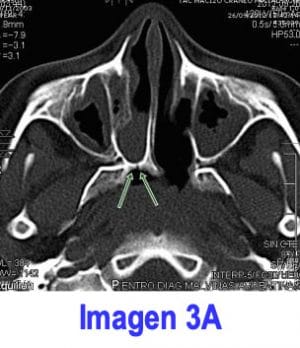 Atresia de Coanas - Diagnóstico Journal
