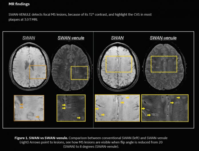 A new optimized 3T SWAN technique detects the central vein sign in MS ...