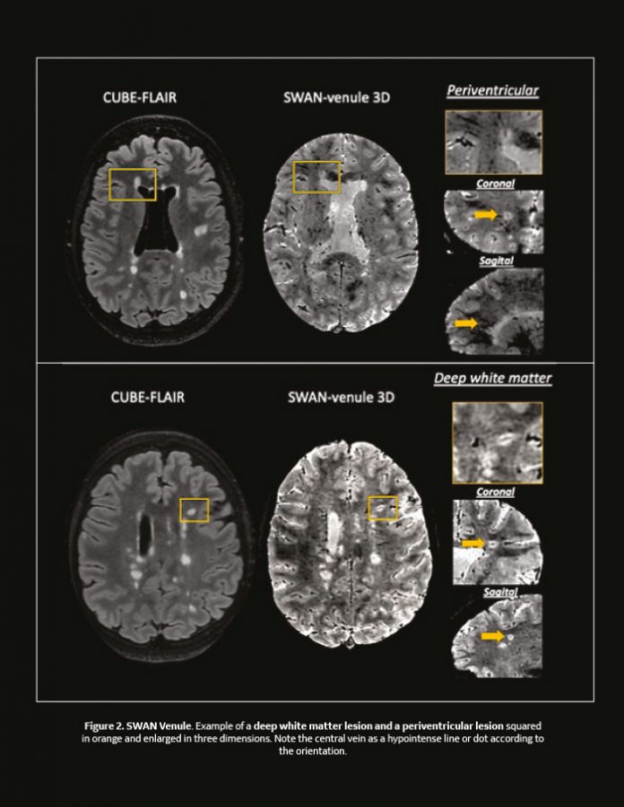 A new optimized 3T SWAN technique detects the central vein sign in MS ...