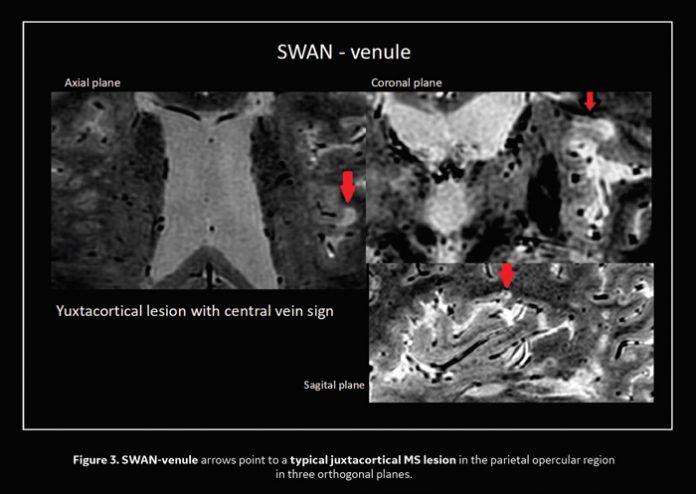 A new optimized 3T SWAN technique detects the central vein sign in MS ...