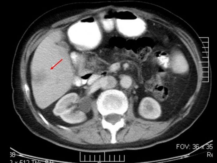 Síndrome de heterotaxia (Situs ambiguo) - Diagnóstico Journal