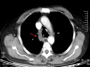 Síndrome de heterotaxia (Situs ambiguo) - Diagnóstico Journal