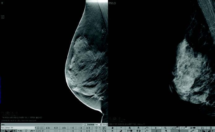 Tomosíntesis 3D Innovación en Patología Mamaria - Diagnóstico Journal