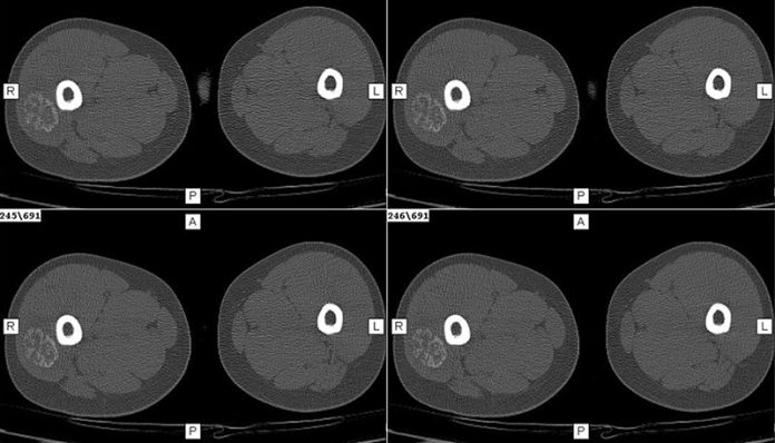 Miositis Osificante. Más allá de un evento traumático - Diagnóstico Journal