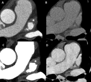 Emerging Role of Spectral Computed Tomography in Neurocardiology ...