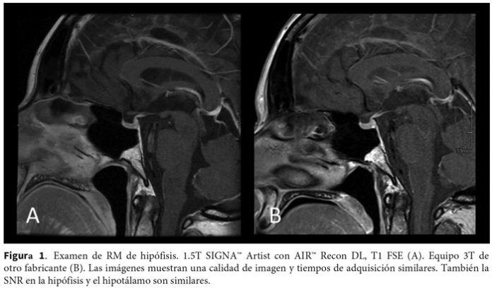 1.5T MRI con AIR™ Recon DL Clínica Alemana de Chile