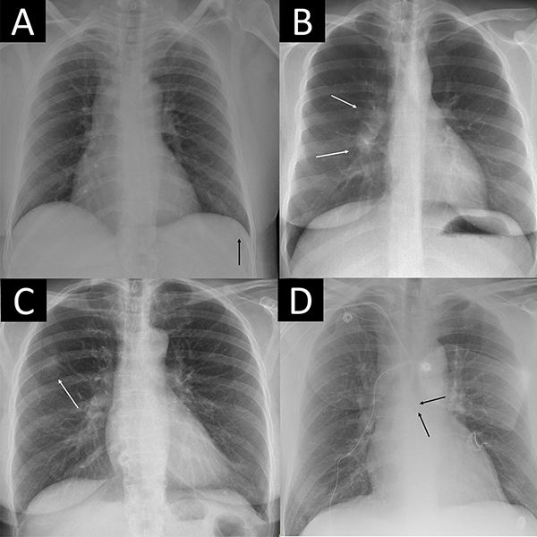 Radiografia De Torax Anormal